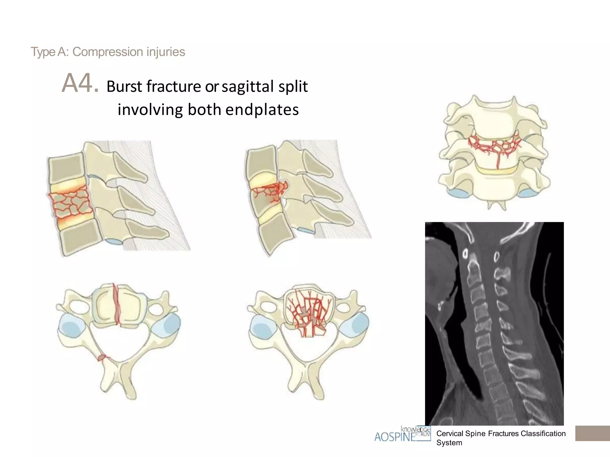 Subaxial spine (2) | PPTX