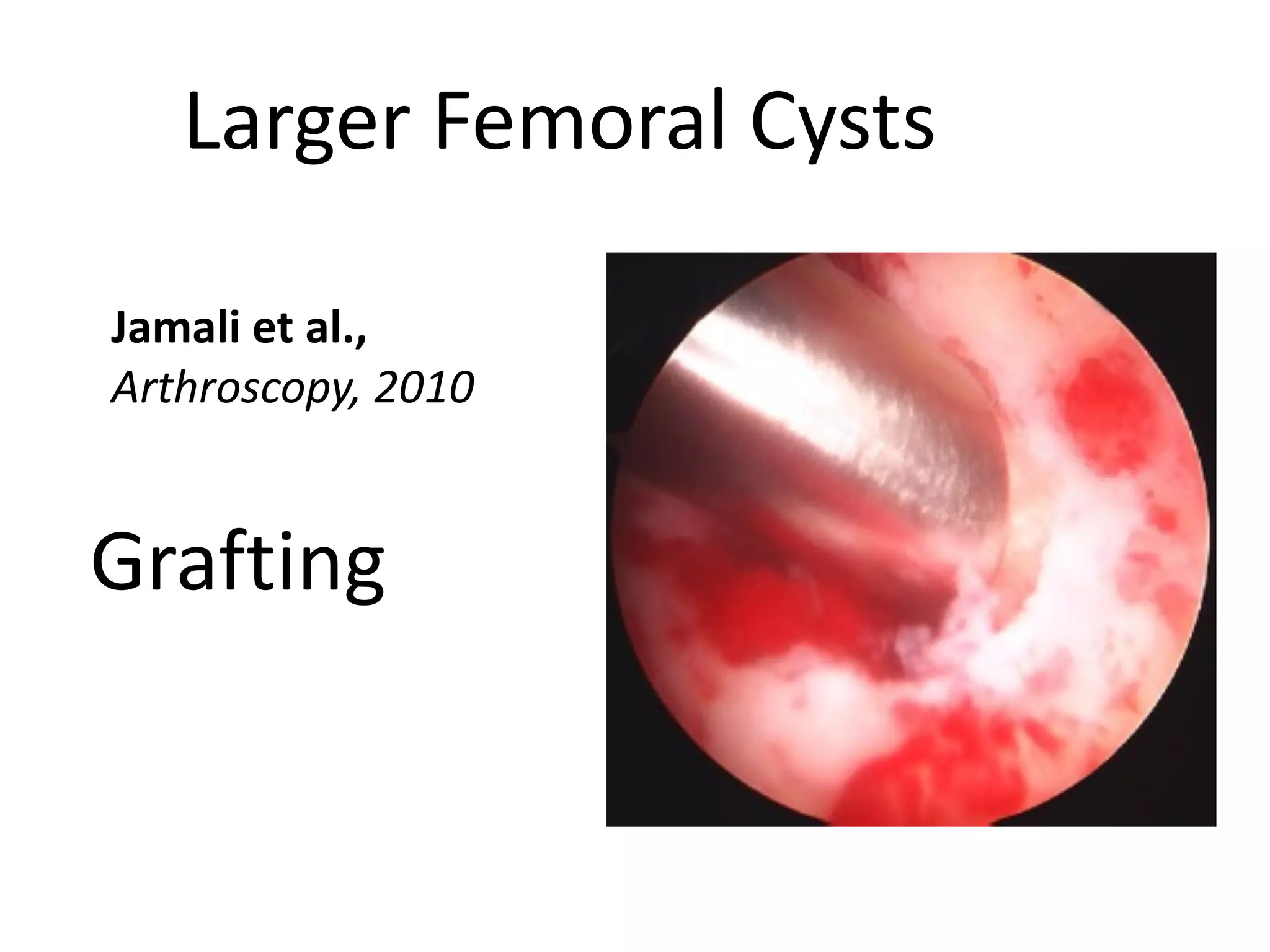 Subchondral cysts | PPT | Free Download