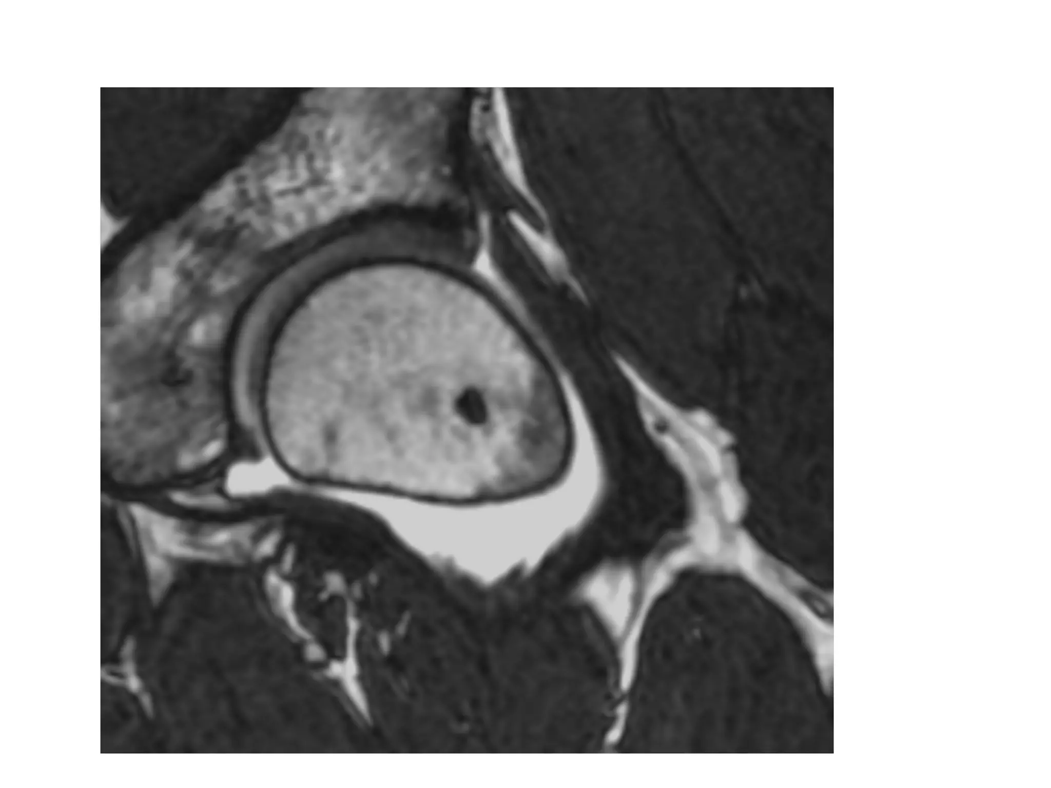Subchondral cysts | PPT