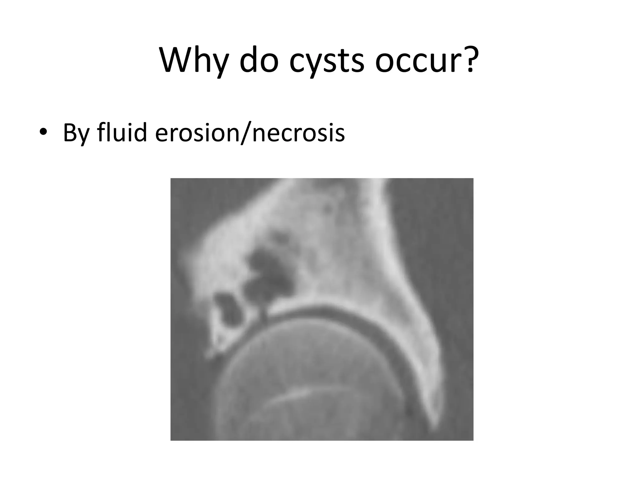 Subchondral cysts | PPT | Free Download