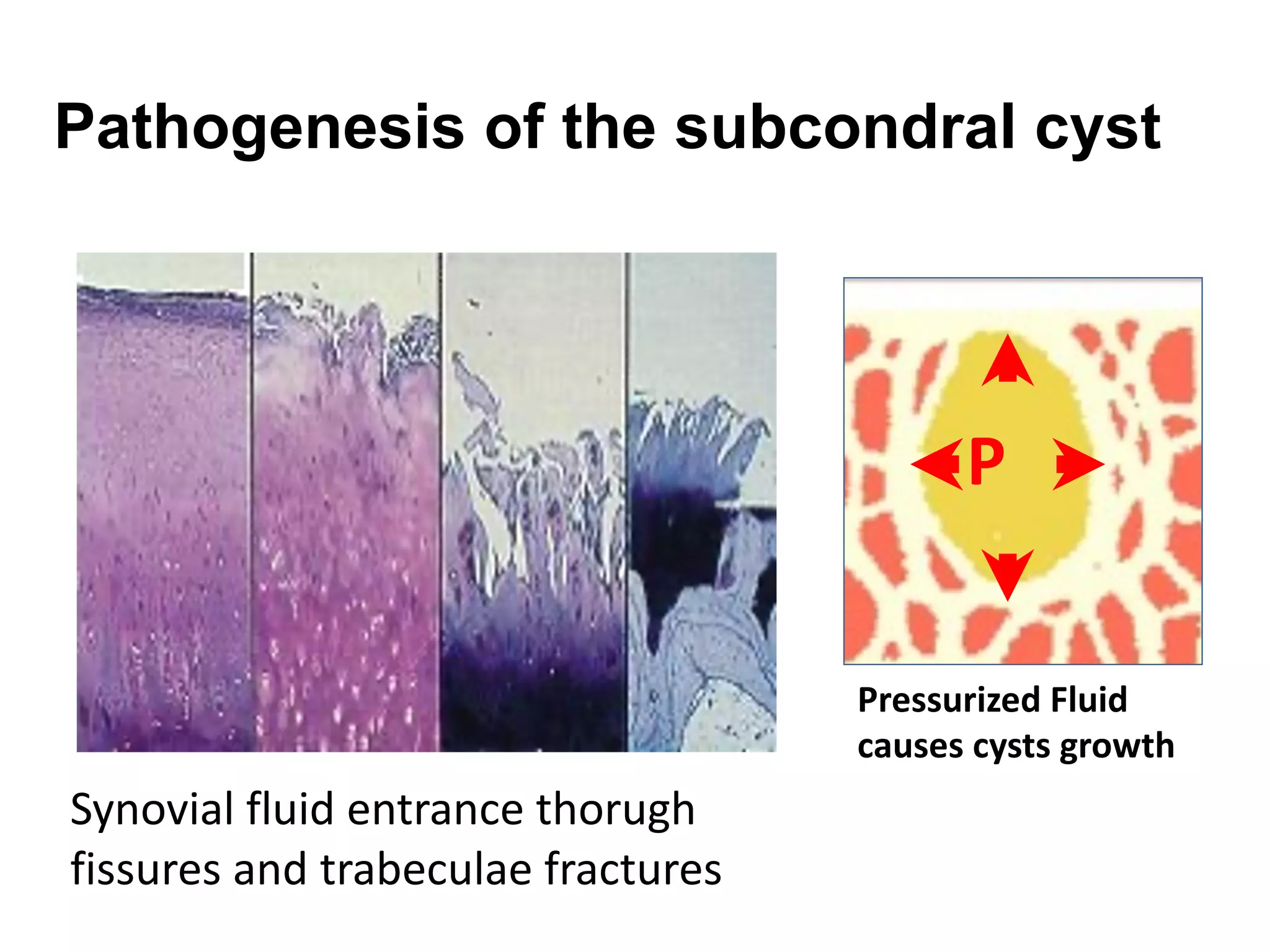 Subchondral cysts | PPT | Free Download
