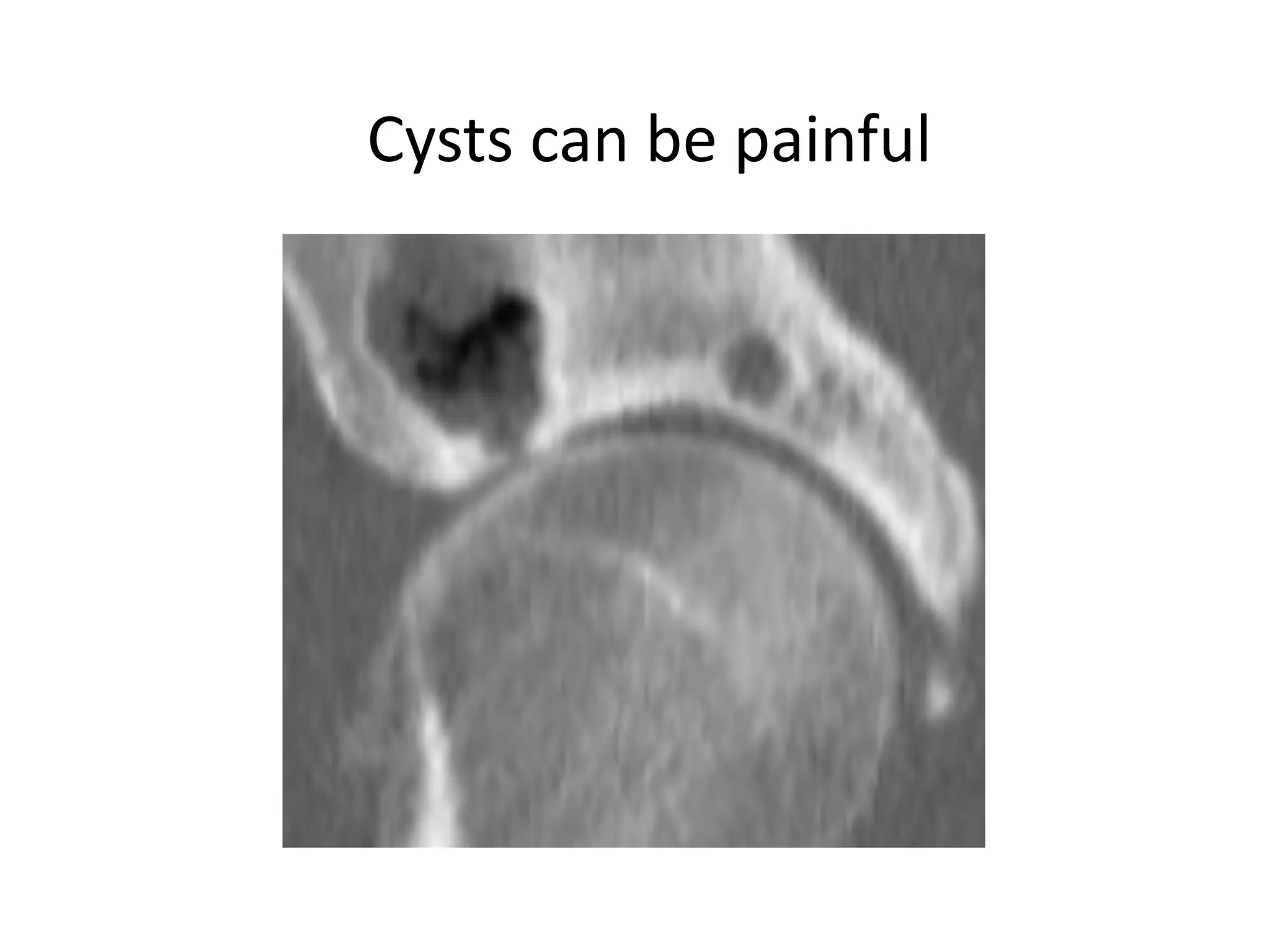 Subchondral cysts | PPT | Free Download
