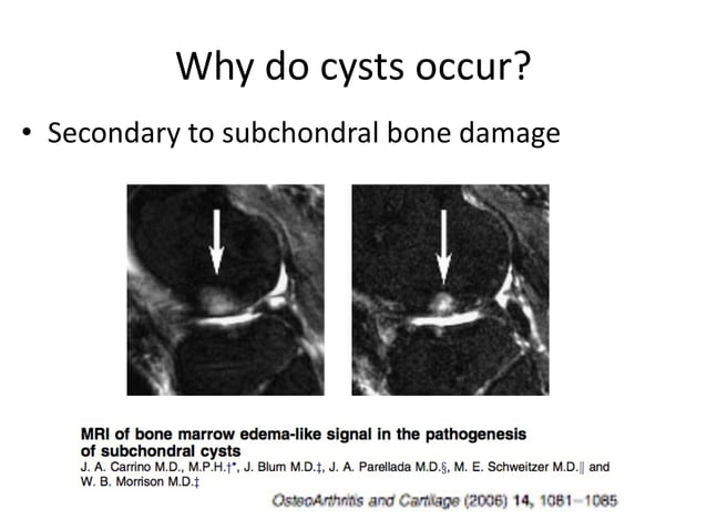 Subchondral cysts | PPT