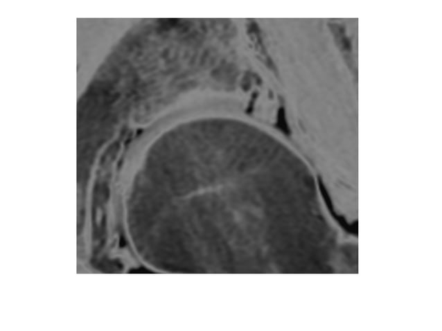 Subchondral cysts | PPT