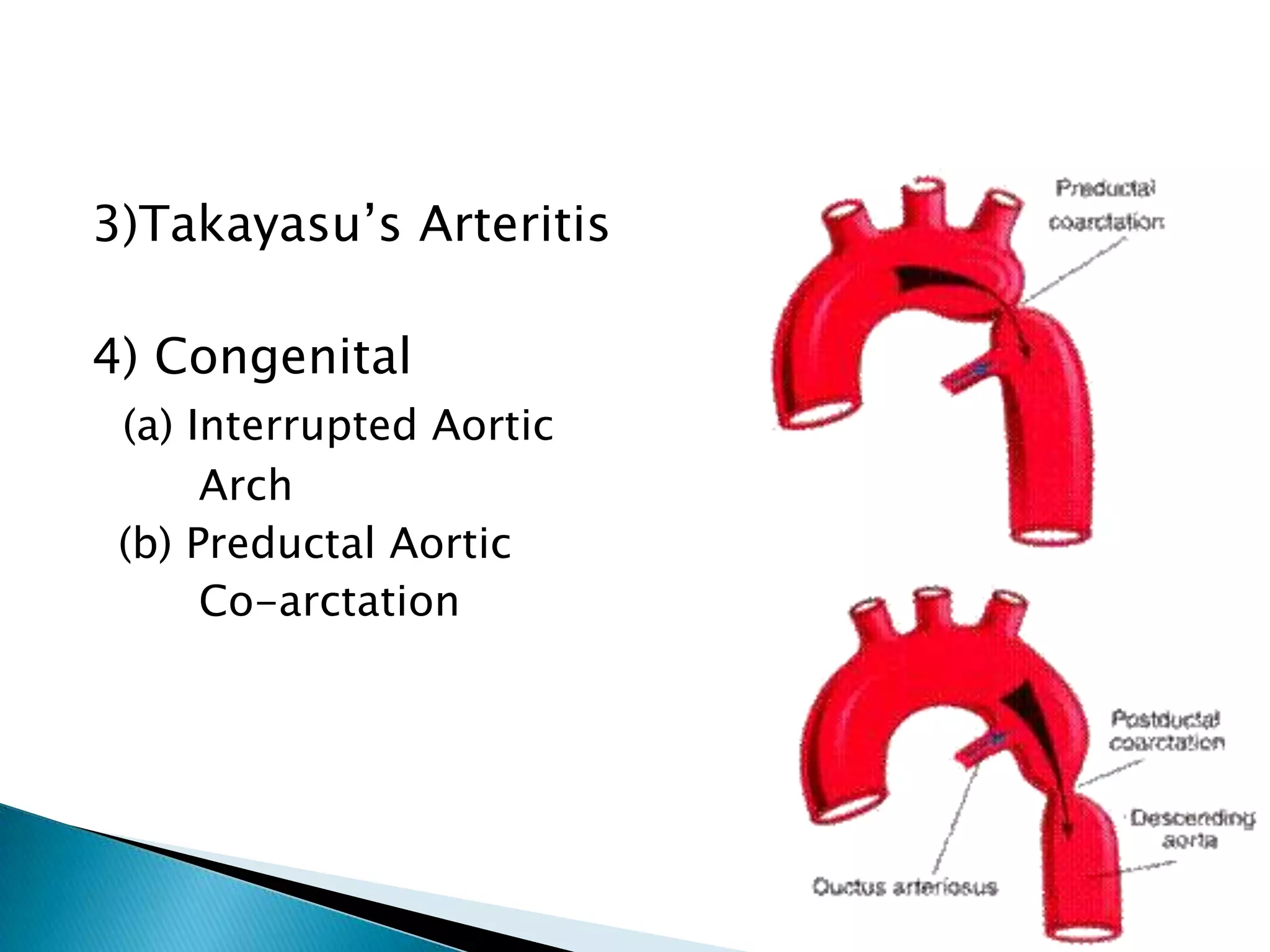 Subclavian steal syndrome | PPTX