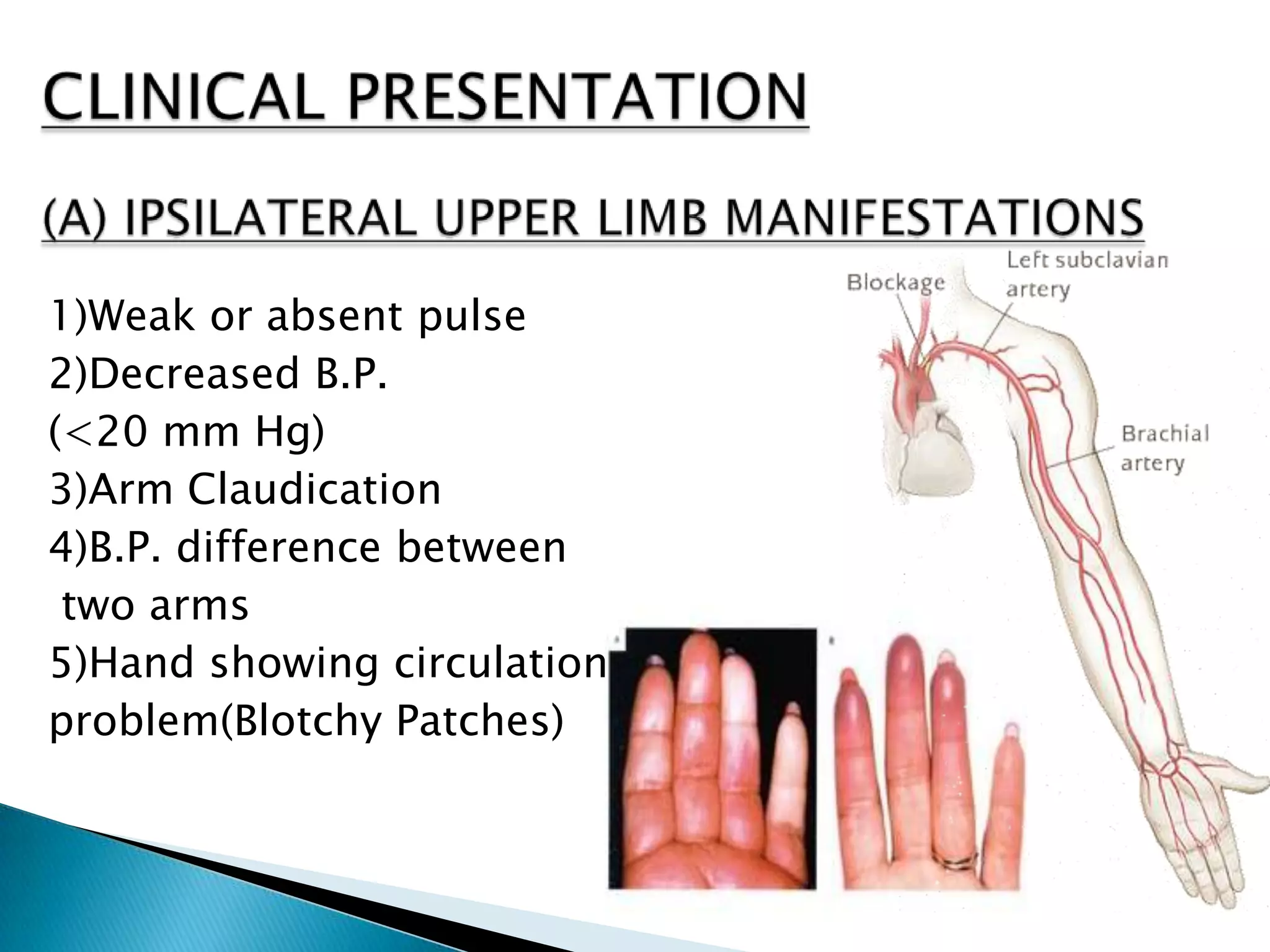 Subclavian steal syndrome | PPTX
