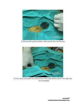 Subclavian Venous Cannulation Made Easy | DOCX
