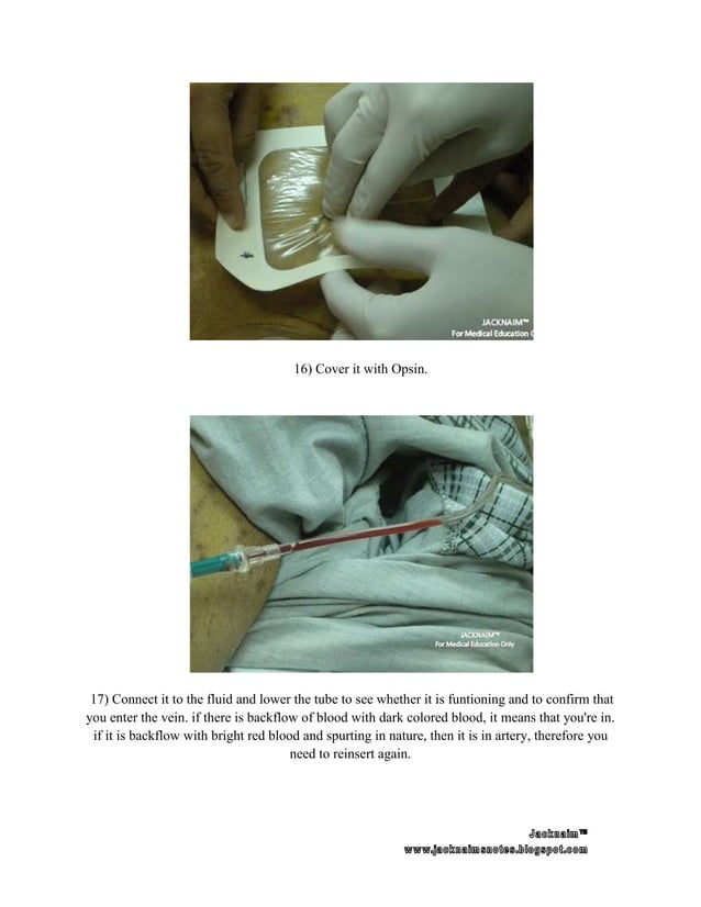 Subclavian Venous Cannulation Made Easy | DOCX | First Aid | Injuries