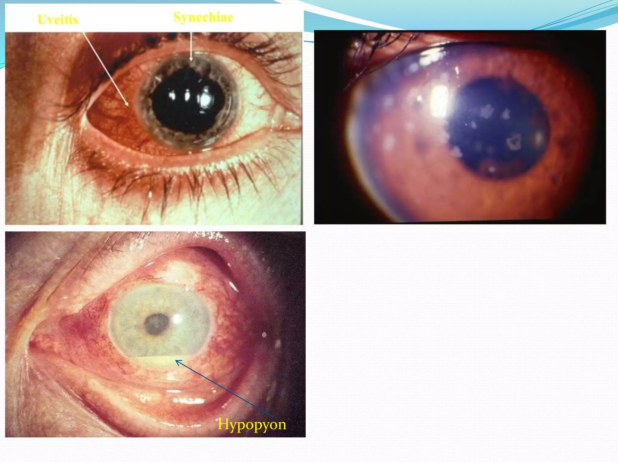 Subconjuctival haemorrhage | PPTX