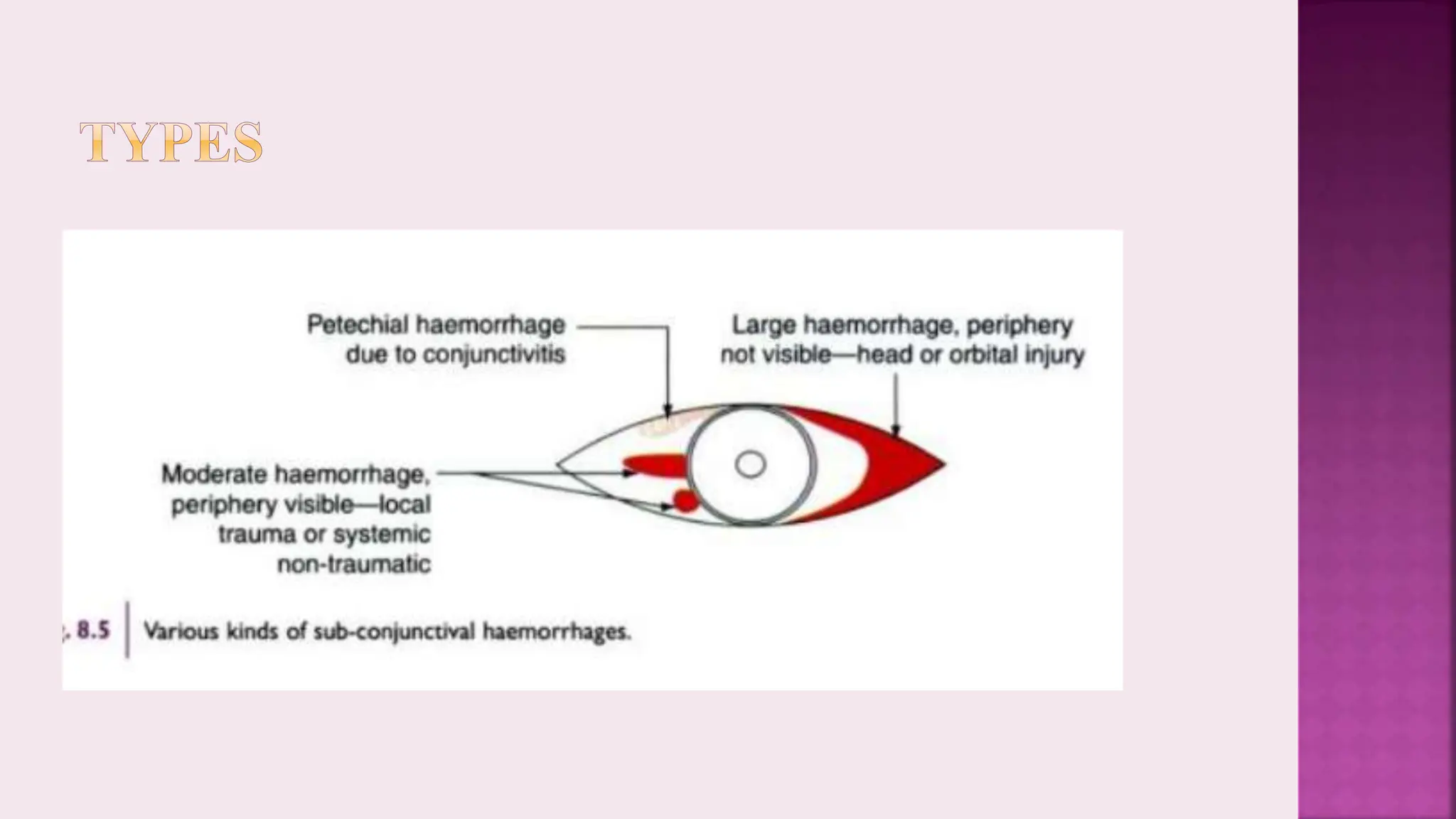 Subconjunctival Haemorrhage,causes,treatment..pptx