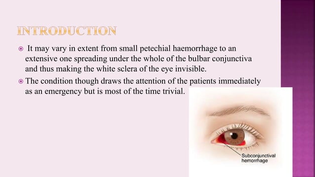Subconjunctival Haemorrhage,causes,treatment..pptx | Eye and Vision ...
