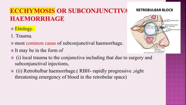 Subconjunctival Haemorrhage,causes,treatment..pptx | Eye and Vision ...