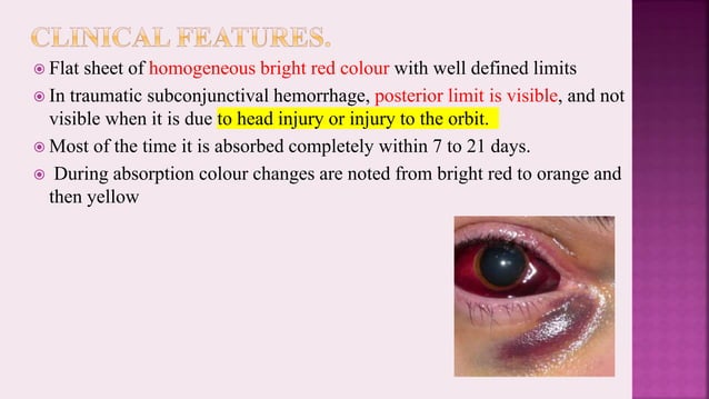 Subconjunctival Haemorrhage,causes,treatment..pptx | Eye and Vision ...