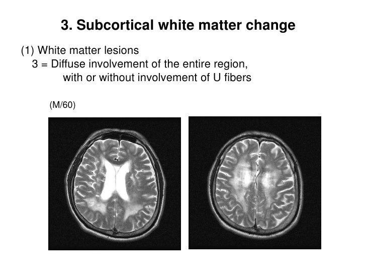 Subcortical lesion-classification-presentation-2011-10-10