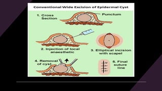Subcutaneous Cyst and its correction.pptx