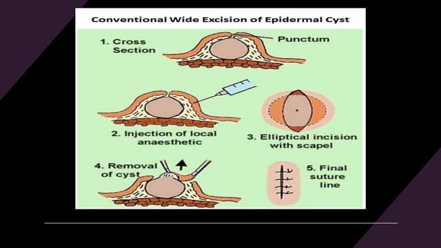 Subcutaneous Cyst and its correction.pptx