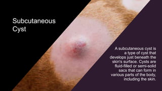 Subcutaneous Cyst and its correction.pptx