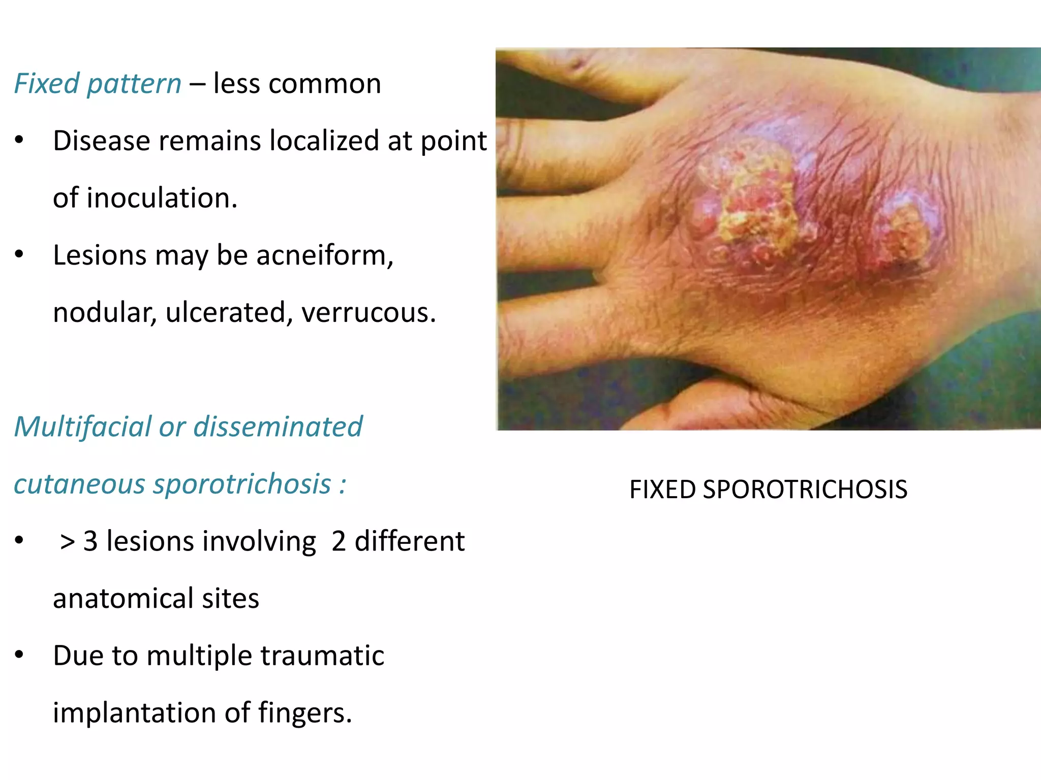 SUBCUTANEOUS AND FUNGAL INFECTIONS | PPTX
