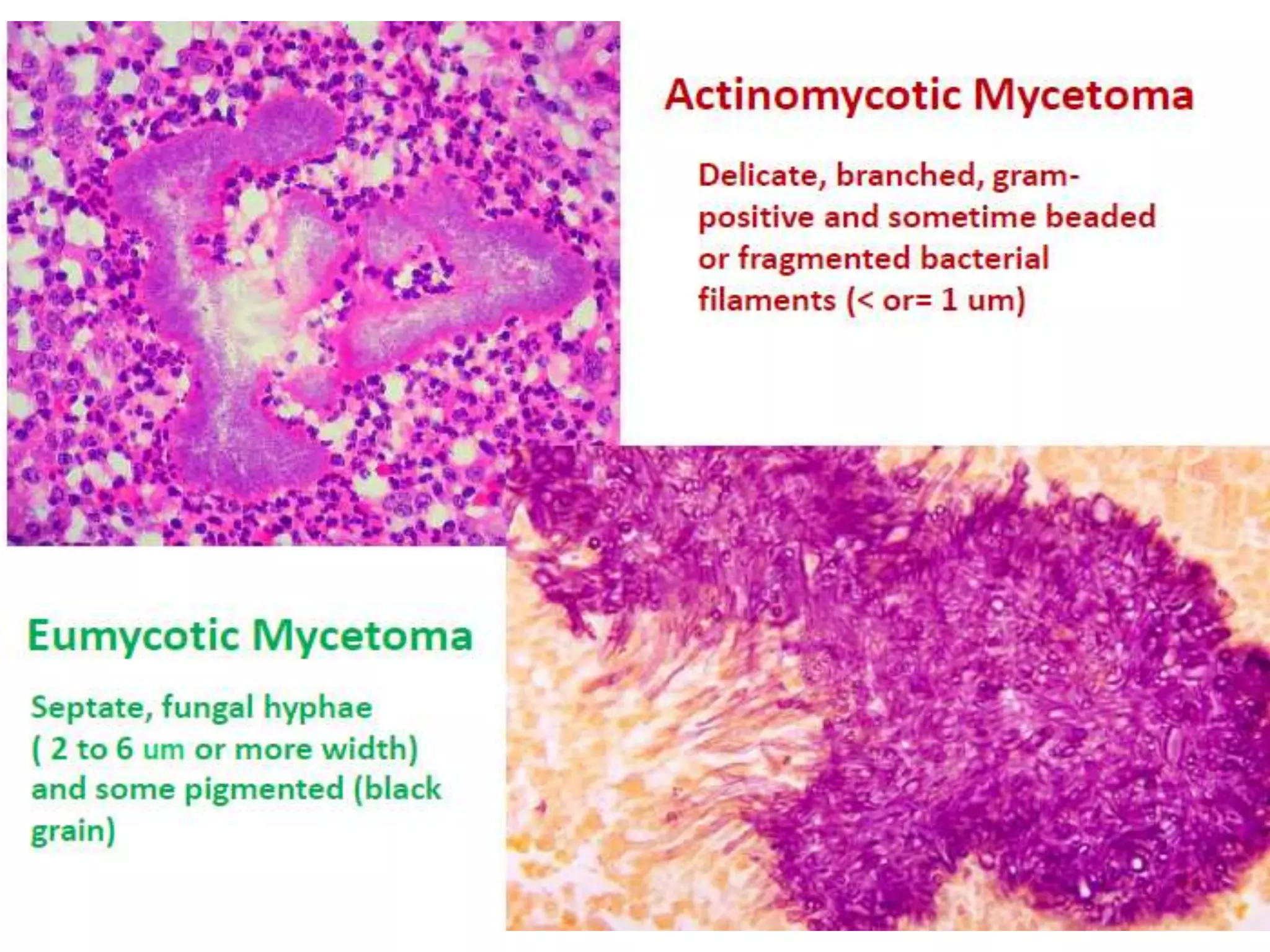 SUBCUTANEOUS AND FUNGAL INFECTIONS | PPTX