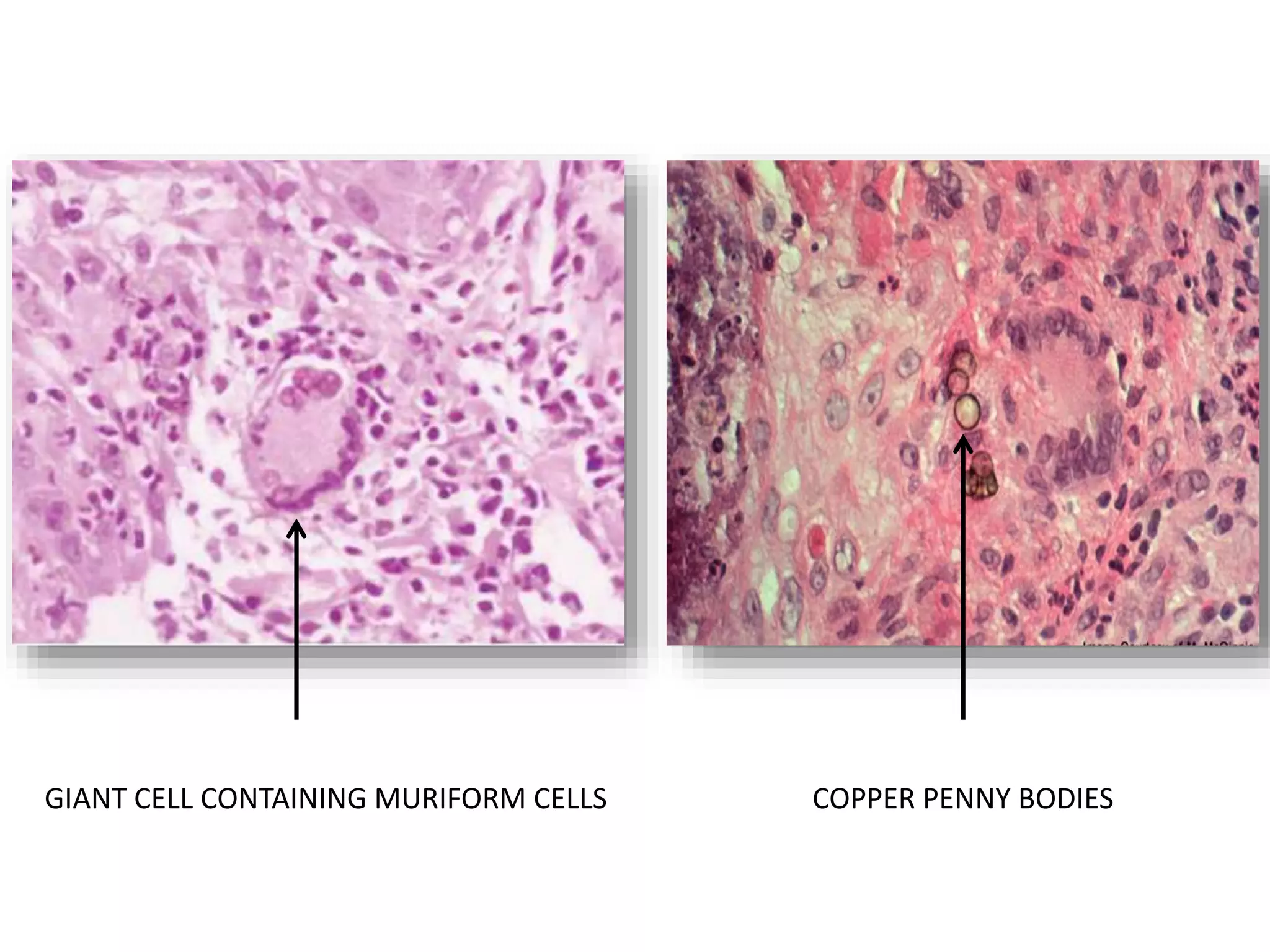 SUBCUTANEOUS AND FUNGAL INFECTIONS | PPTX