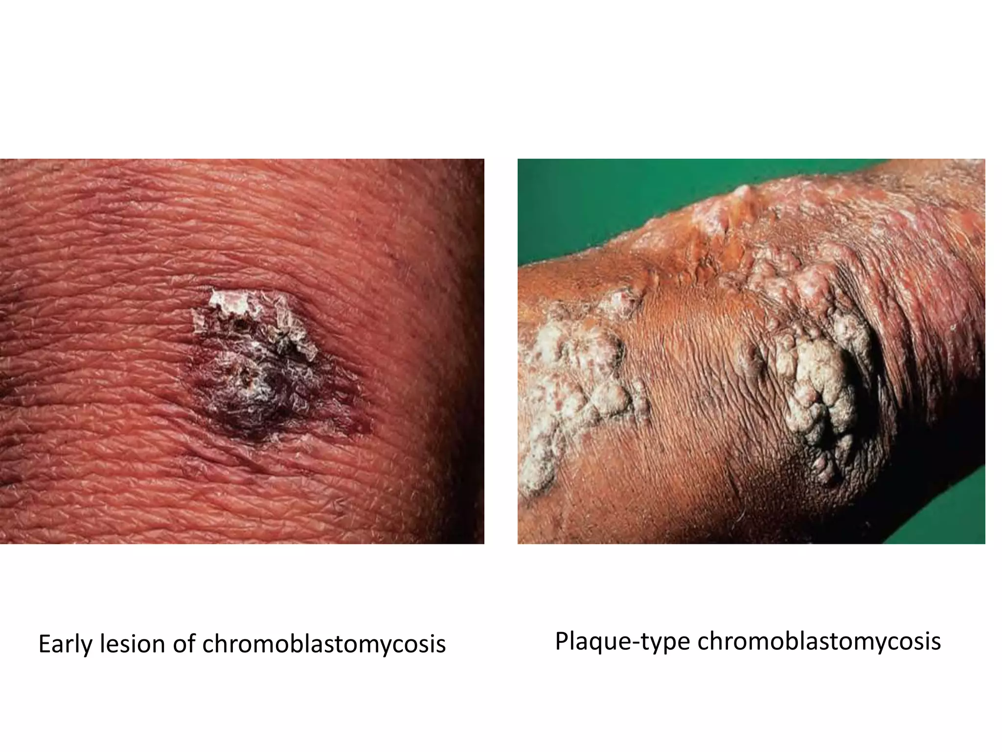 SUBCUTANEOUS AND FUNGAL INFECTIONS | PPTX