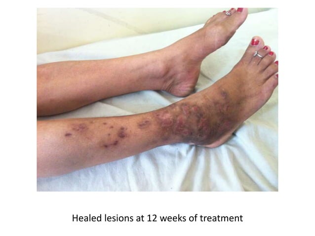 SUBCUTANEOUS AND FUNGAL INFECTIONS | PPTX | Skin and Dermatology ...