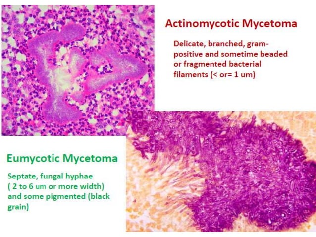 Subcutaneous And Fungal Infections Ppt