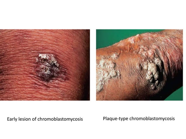 Subcutaneous And Fungal Infections Ppt