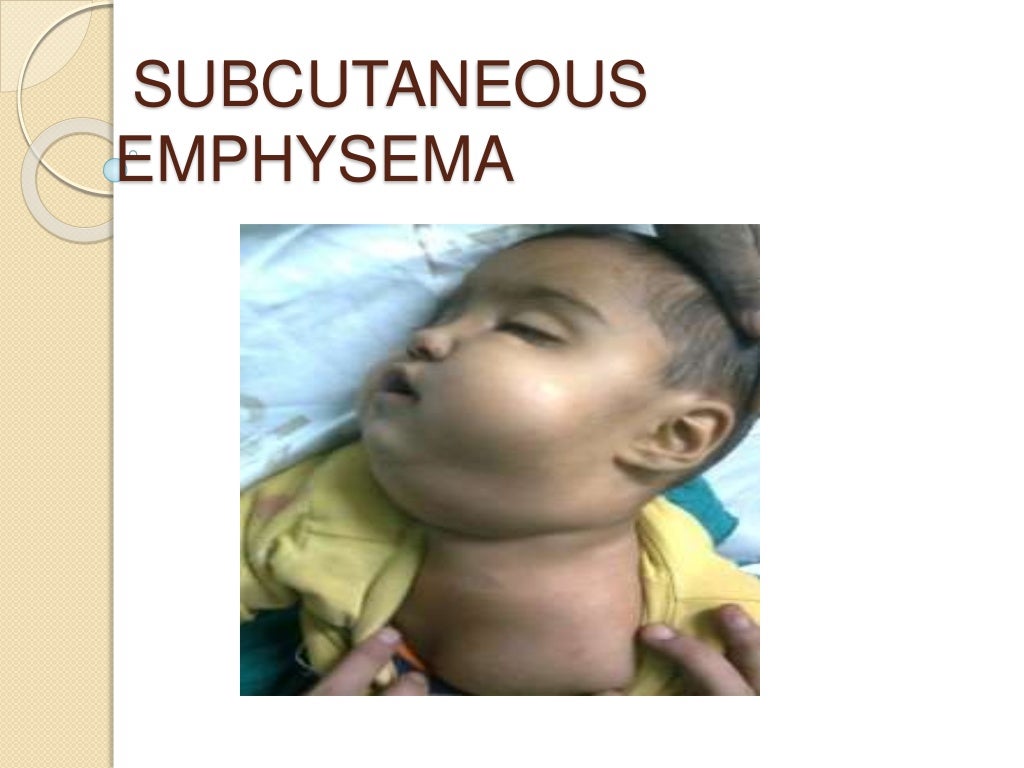 Subcutaneous emphysema
