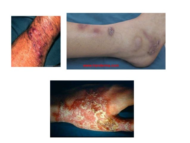 Subcutaneous mycoses