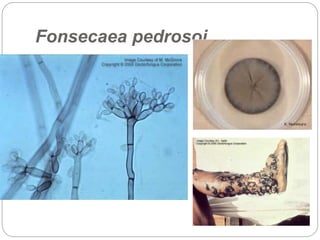 Fonsecaea Compacta