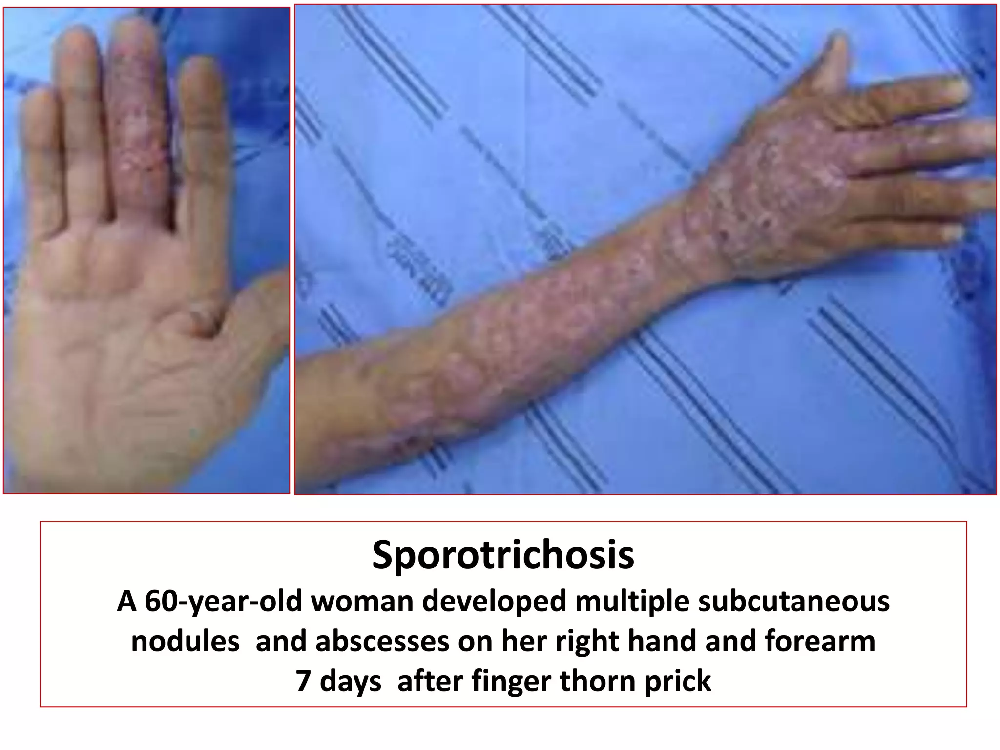 Subcutaneous mycoses.ppt