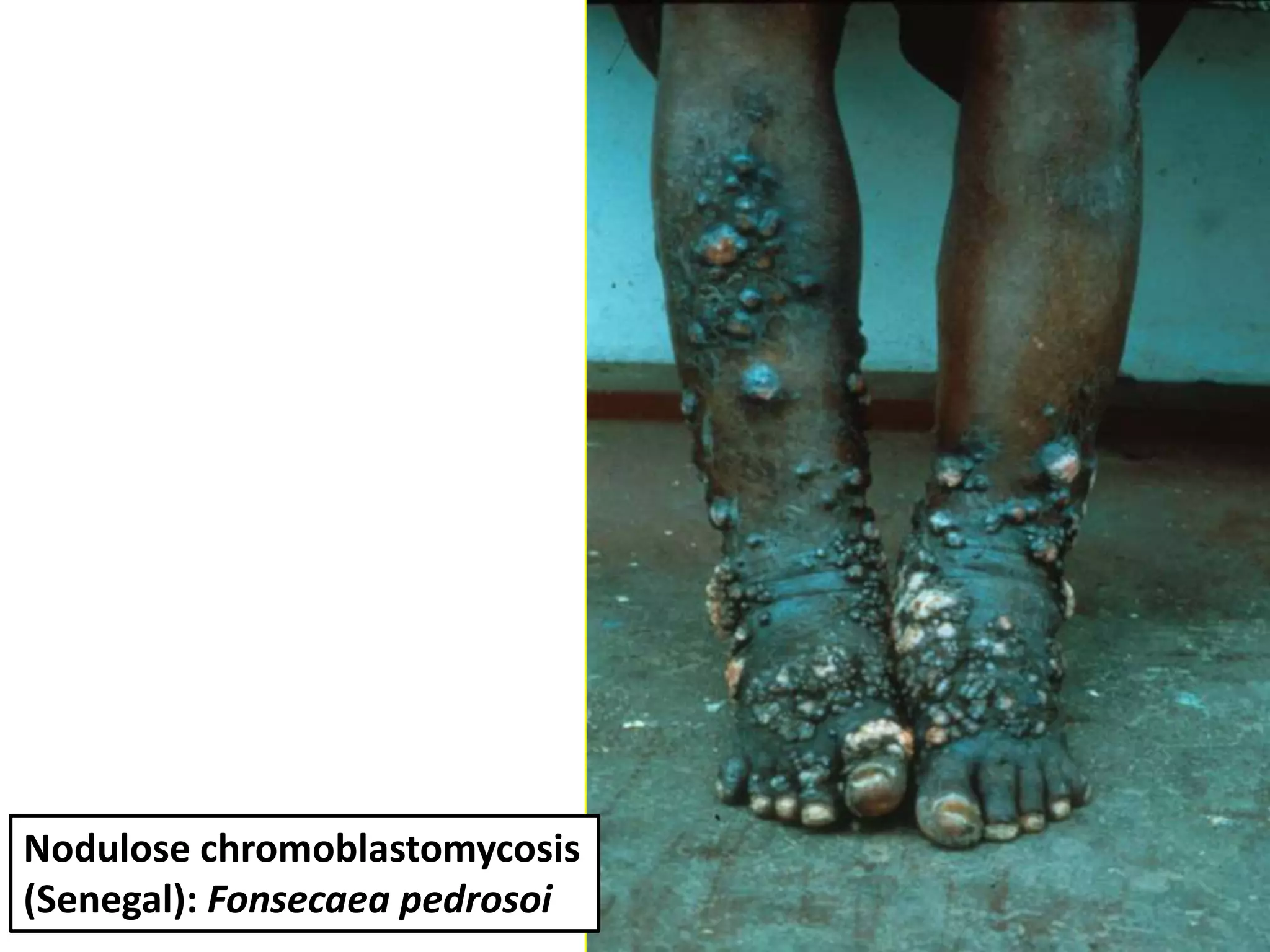 Subcutaneous mycoses.ppt | Foot Health | Diseases and Conditions