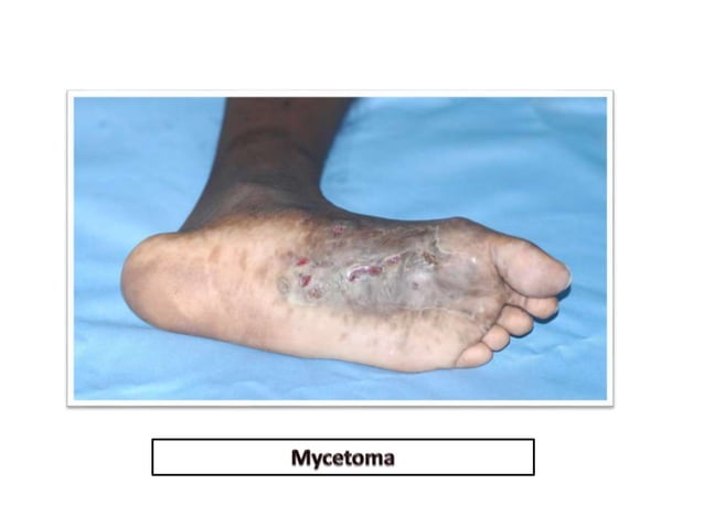 Subcutaneous mycoses.ppt | Foot Health | Diseases and Conditions