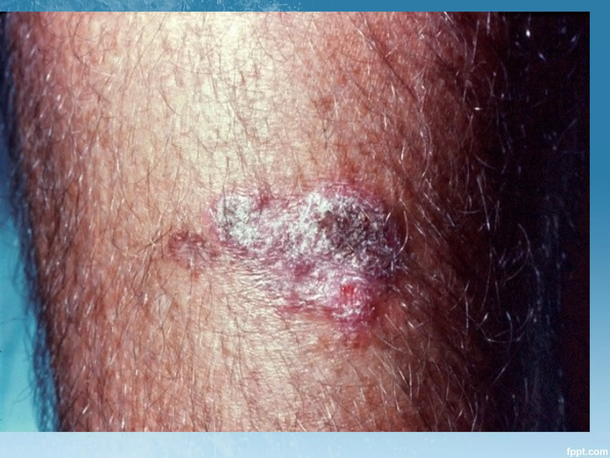 Subcutaneous mycoses by Dr. Rakesh Prasad Sah | PPT