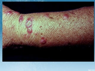 Subcutaneous mycoses by Dr. Rakesh Prasad Sah | PPT