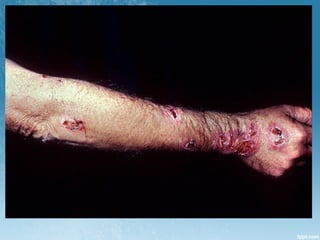 Subcutaneous mycoses by Dr. Rakesh Prasad Sah | PPT