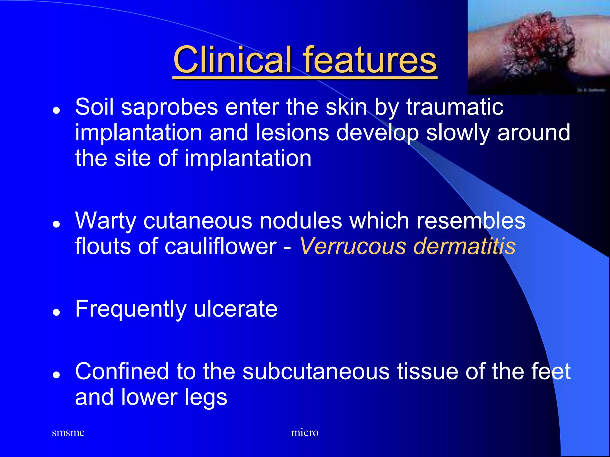 Subcutaneous mycoses | PPT | Infectious Diseases | Diseases and Conditions