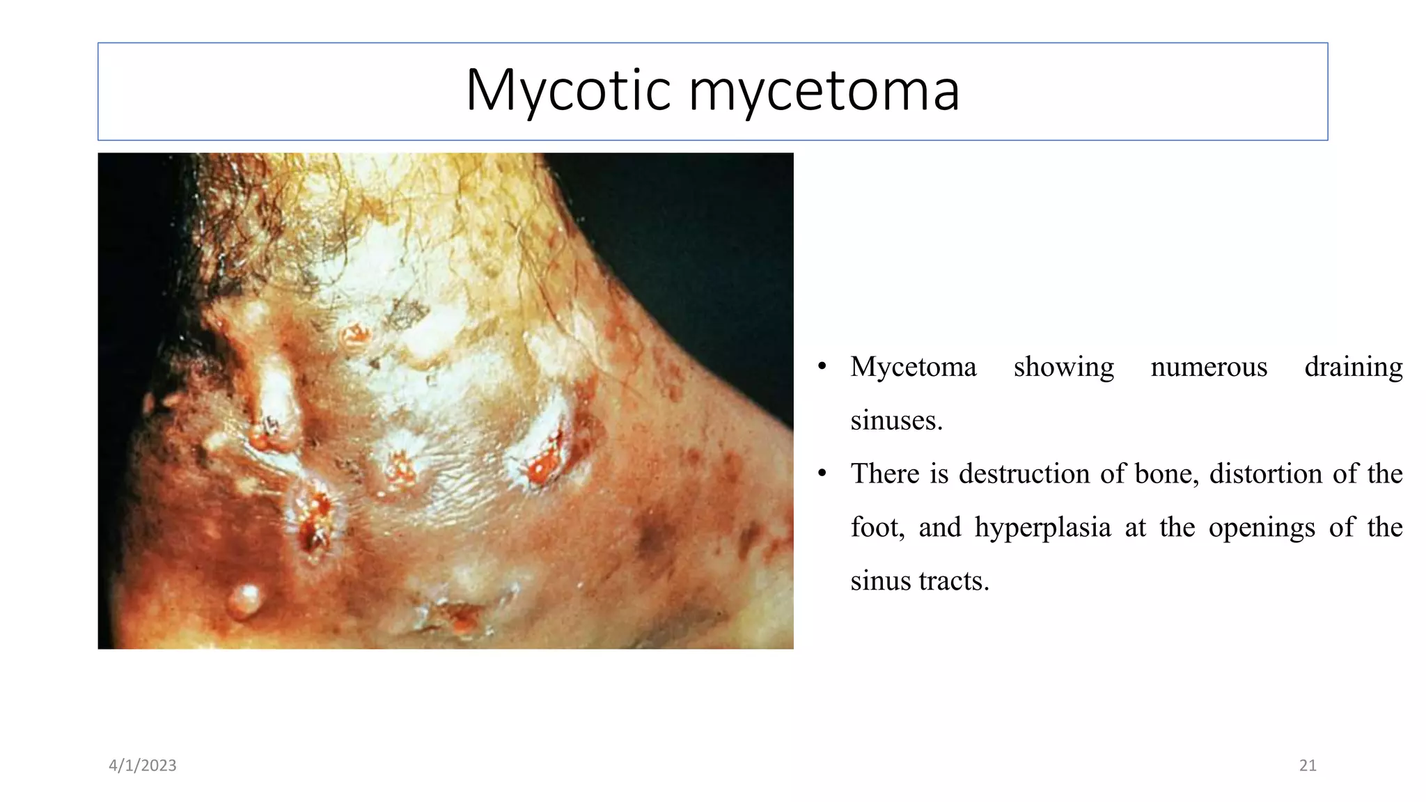 Subcutaneous Mycoses.pptx