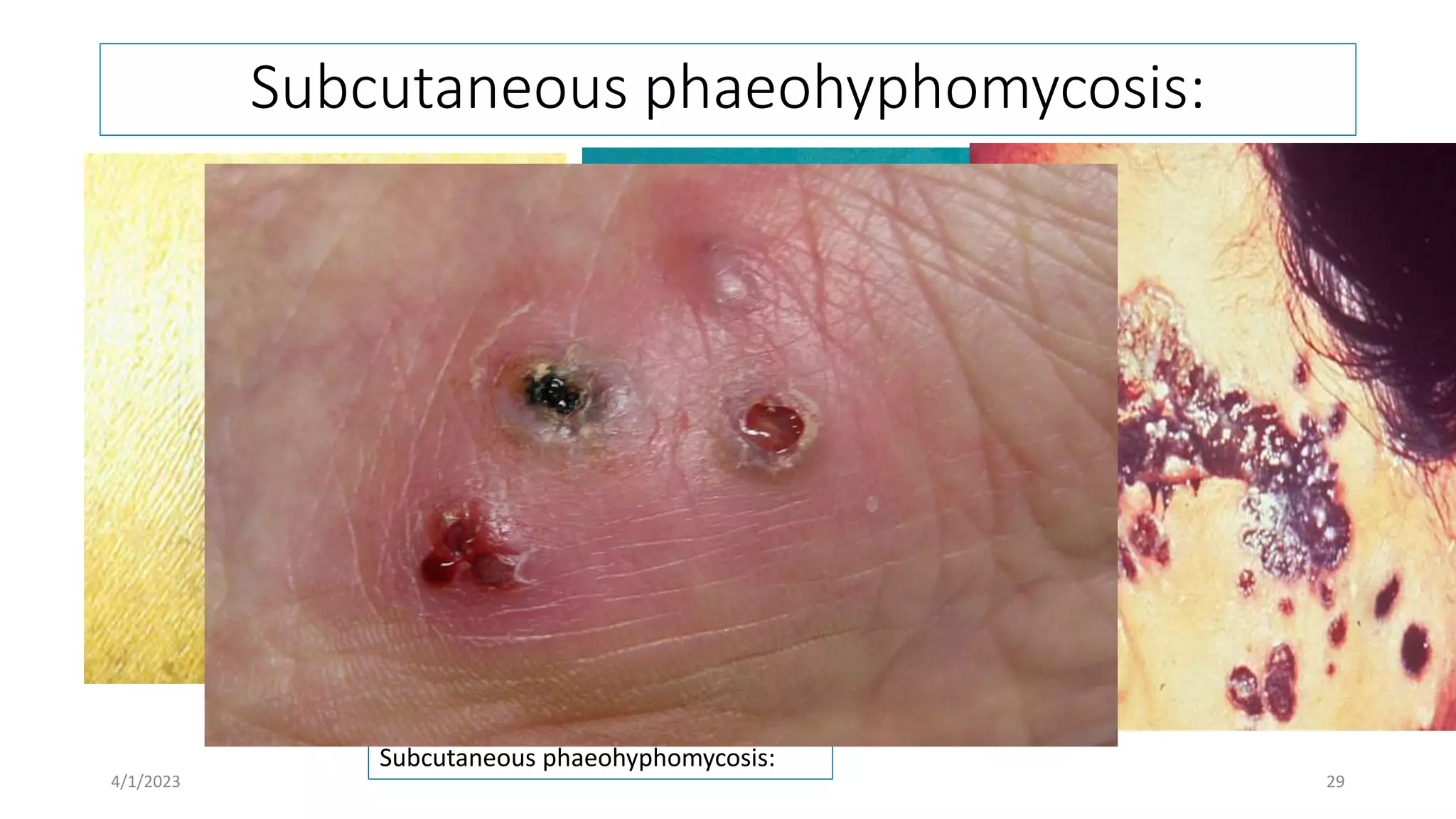 Subcutaneous Mycoses.pptx