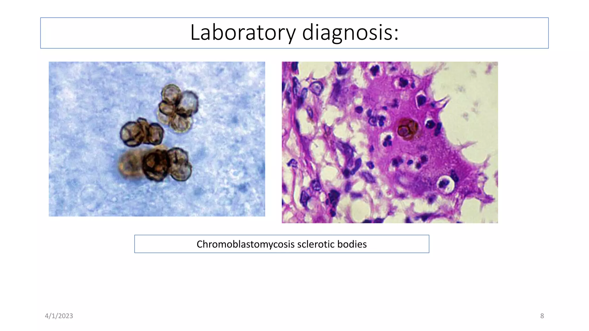 Subcutaneous Mycoses.pptx