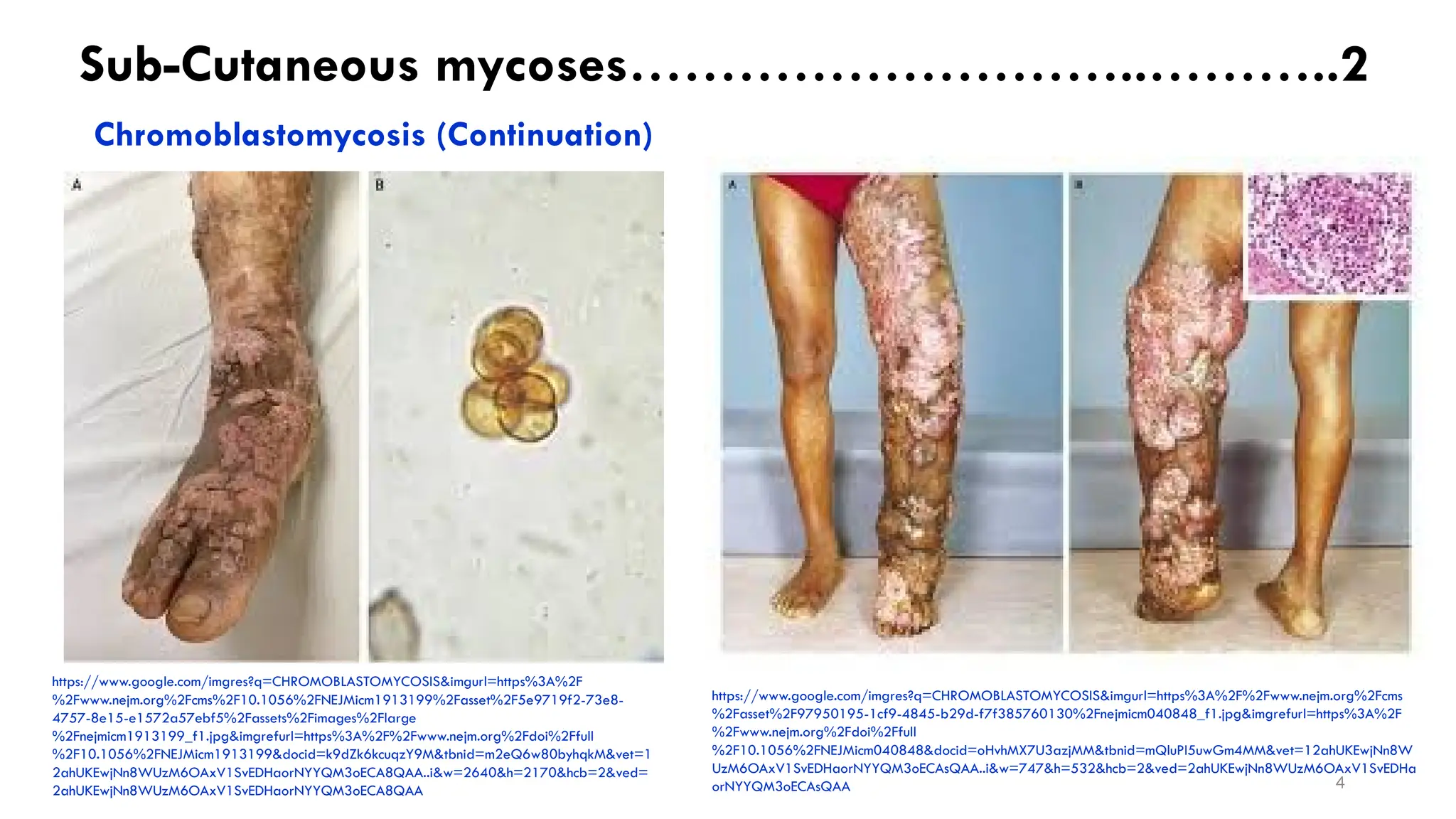 Subcutaneous Mycoses _ 19-July-2025 _ DCA-1.pptx