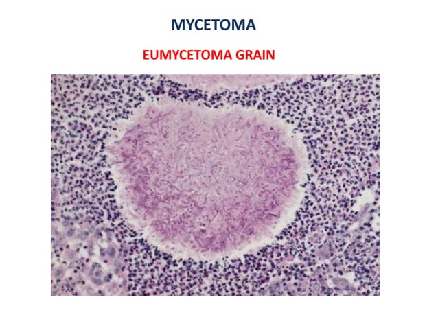 Subcutaneous Mycosis | PPTX | Skin and Dermatology | Diseases and ...
