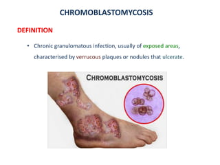 Subcutaneous Mycosis | PPTX