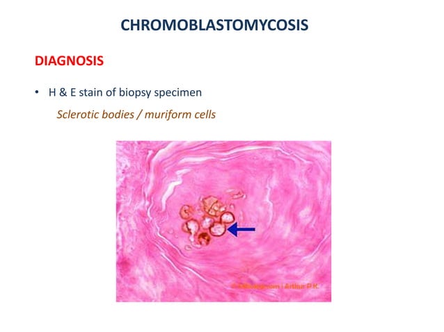 Subcutaneous Mycosis | PPT