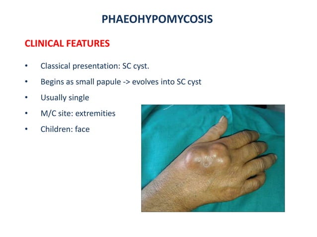 Subcutaneous Mycosis | PPTX | Skin and Dermatology | Diseases and ...