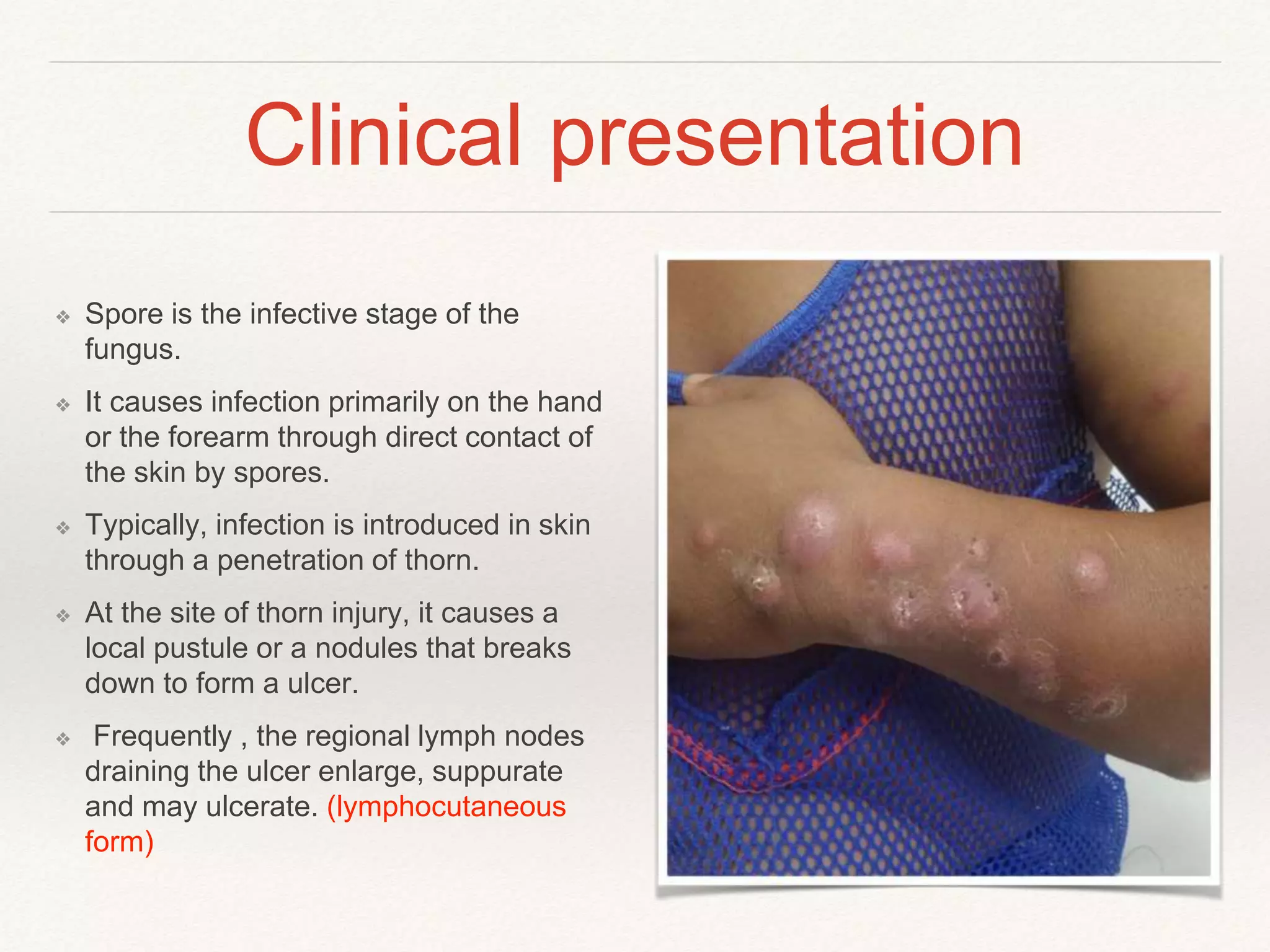 Subcutaneous mycosis | PPTX