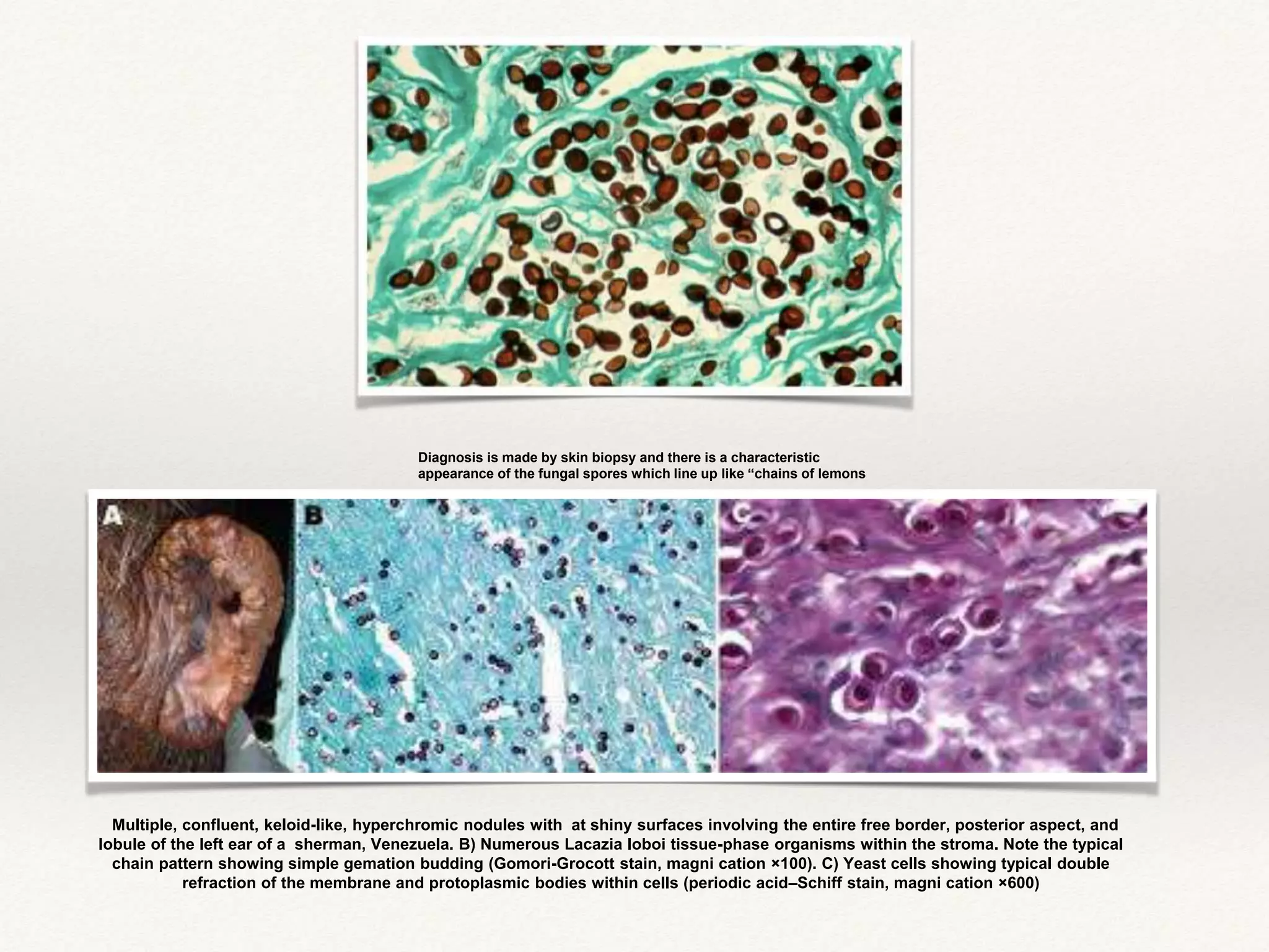 Subcutaneous mycosis | PPTX