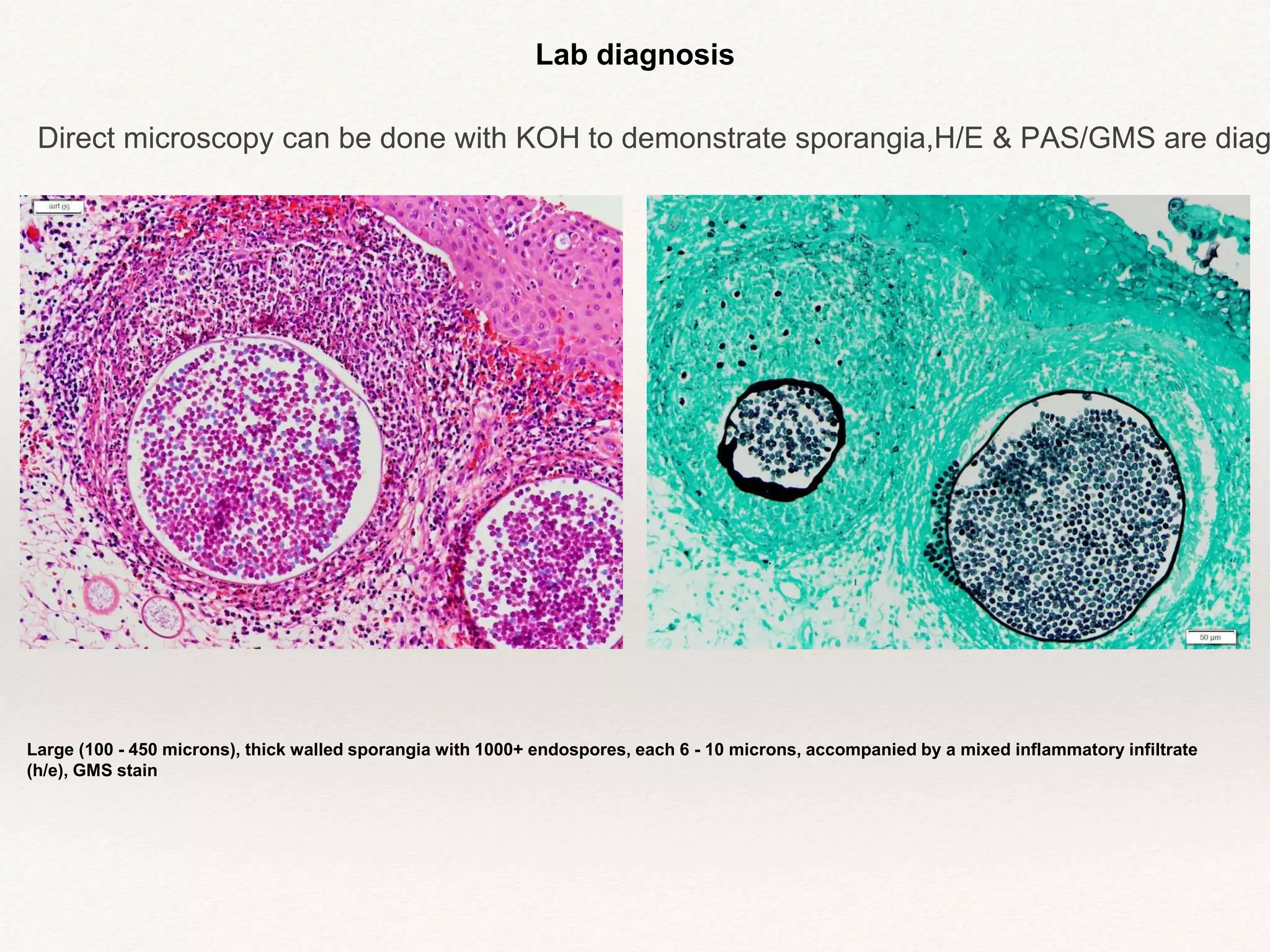 Subcutaneous mycosis | PPTX