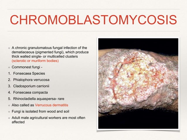Subcutaneous mycosis | PPT